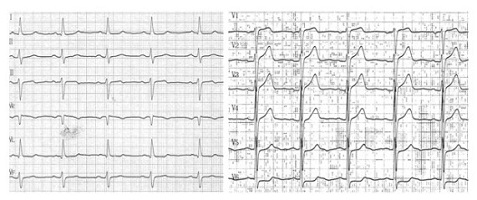 What is arrhythmia? – 牧港中央病院-English